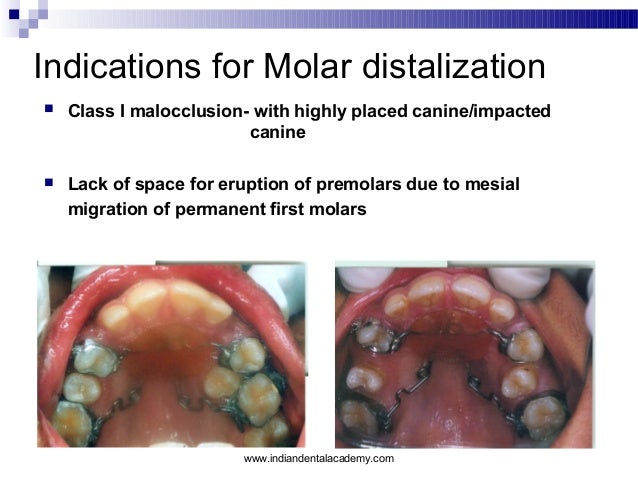 Molar distalization /certified fixed orthodontic courses by Indian de…