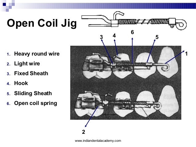 Molar distalization /certified fixed orthodontic courses by Indian de…