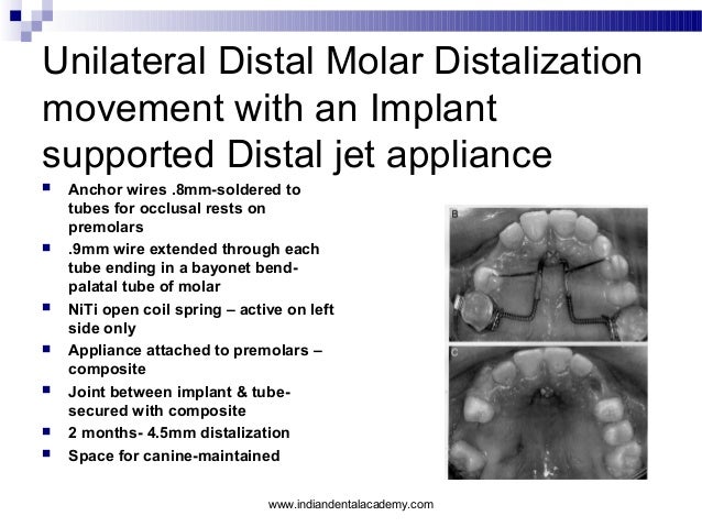 Molar distalization /certified fixed orthodontic courses by Indian de…