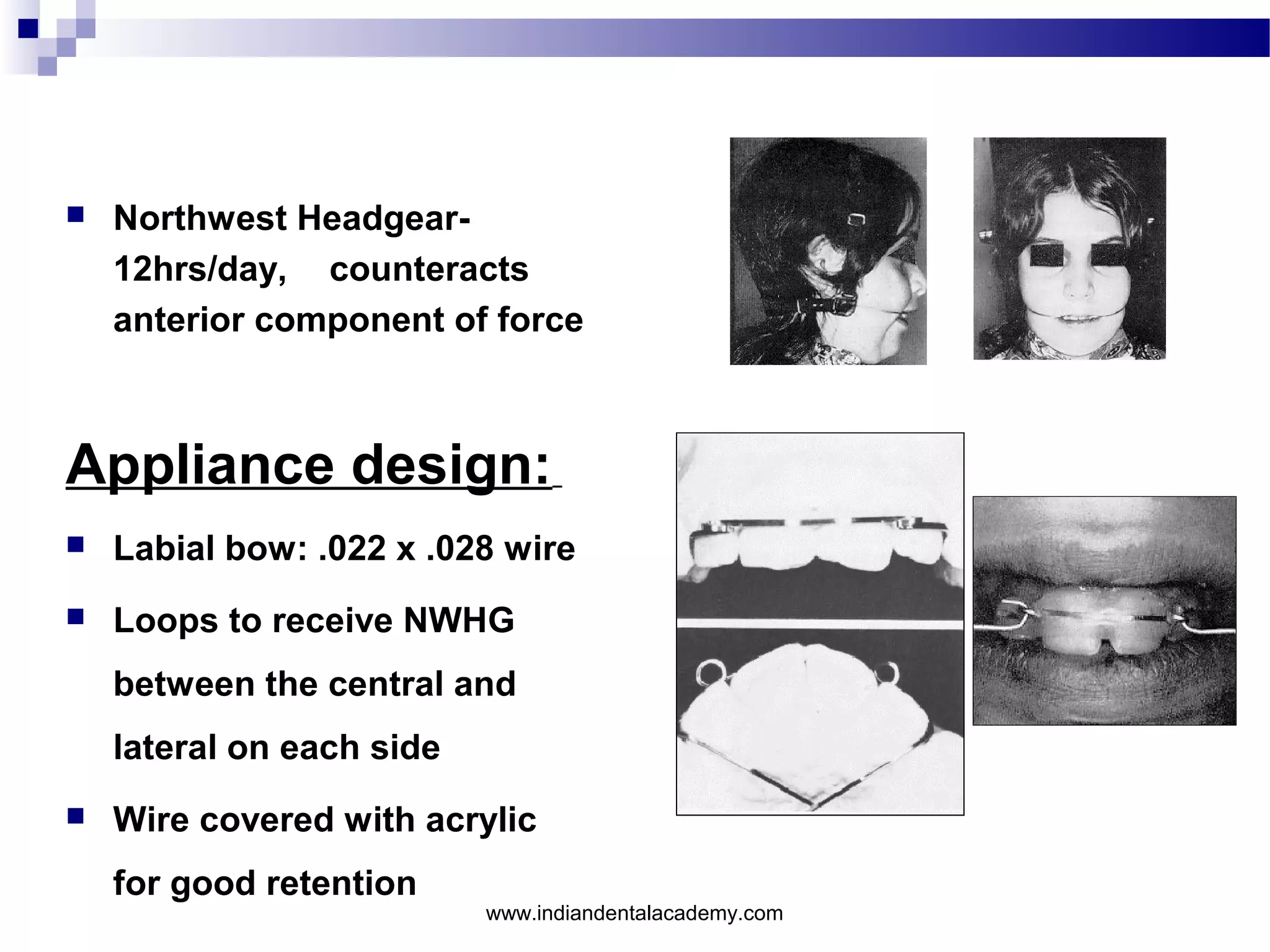 Molar distalization | PPT