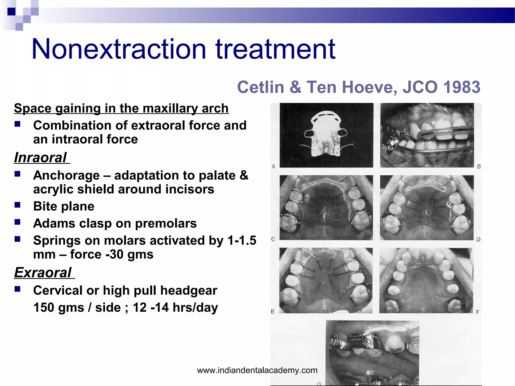 Molar distalization | PPT