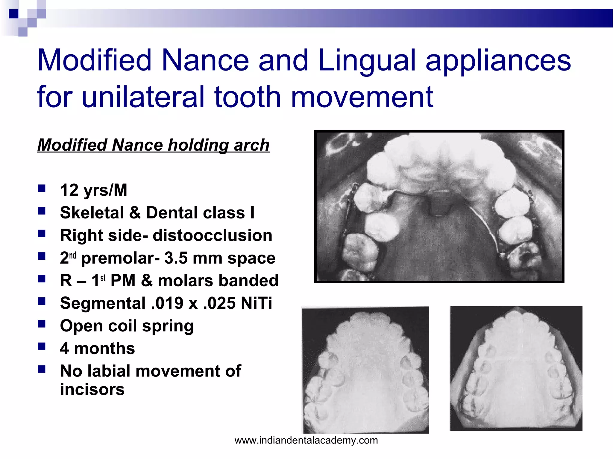 Molar distalization | PPT