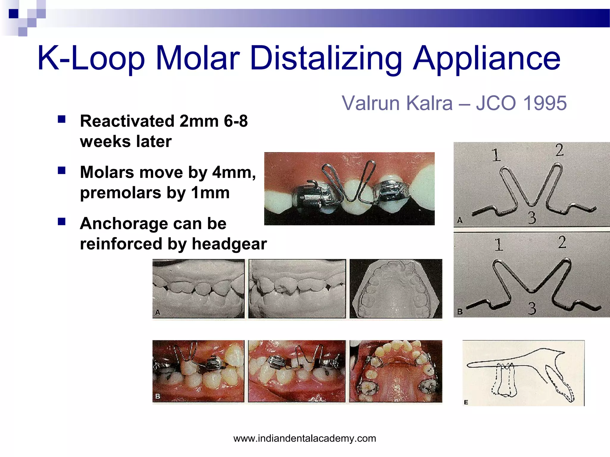 Molar distalization | PPT