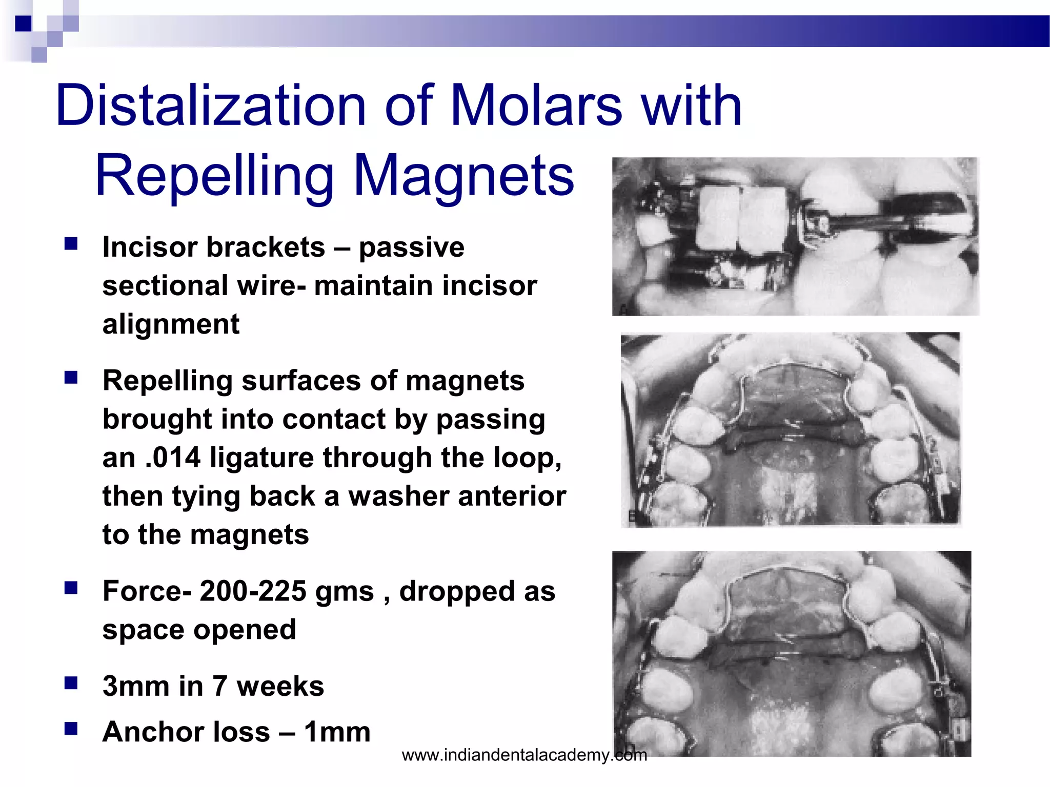 Molar distalization | PPT