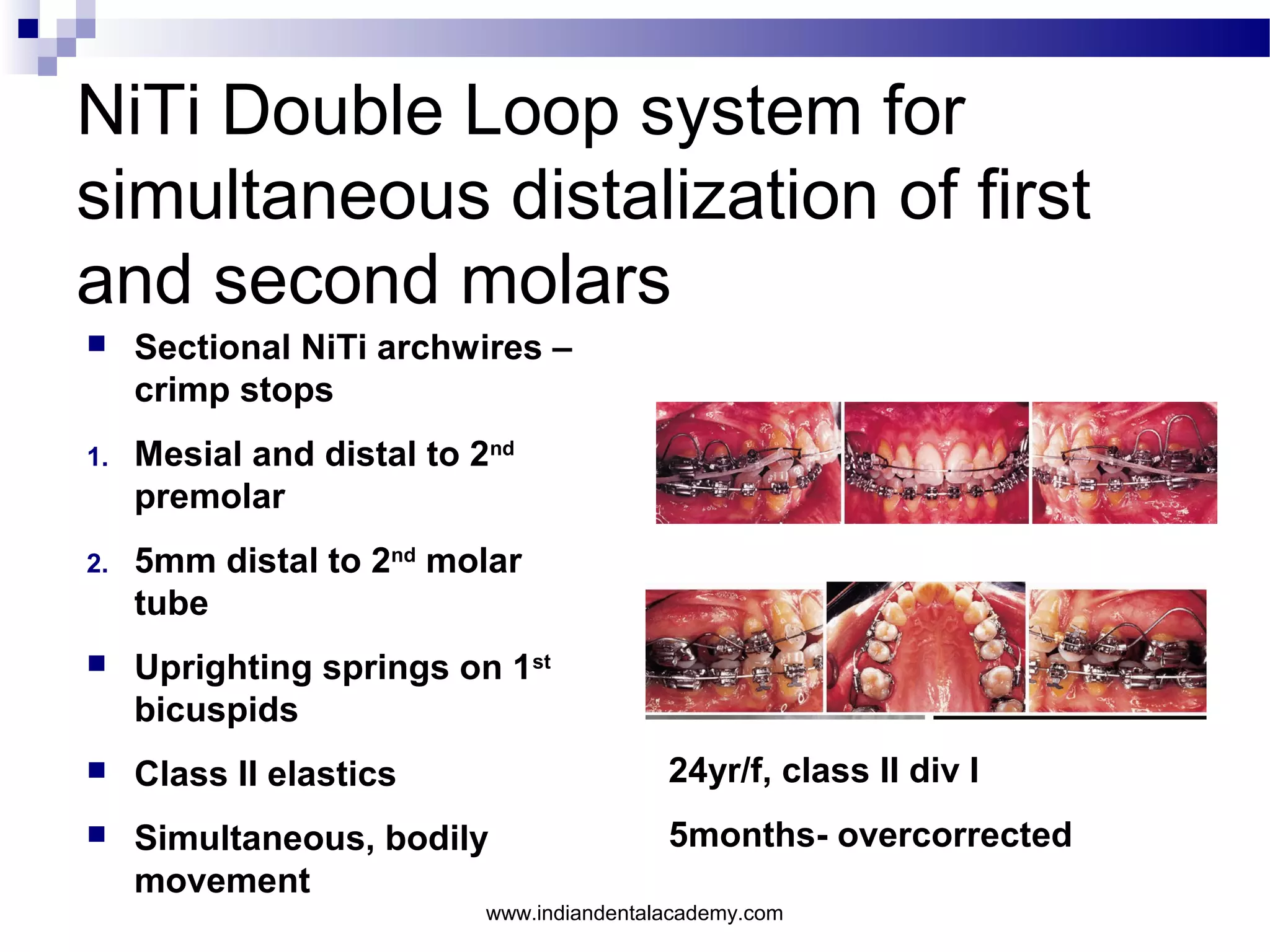 Molar distalization | PPT