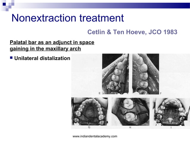 Molar distalization | PPT | Dental Health | Diseases and Conditions