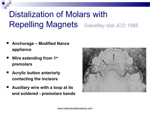 Molar distalization | PPT | Dental Health | Diseases and Conditions