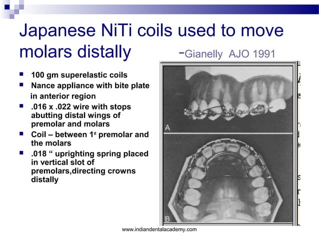 Molar distalization | PPT | Dental Health | Diseases and Conditions