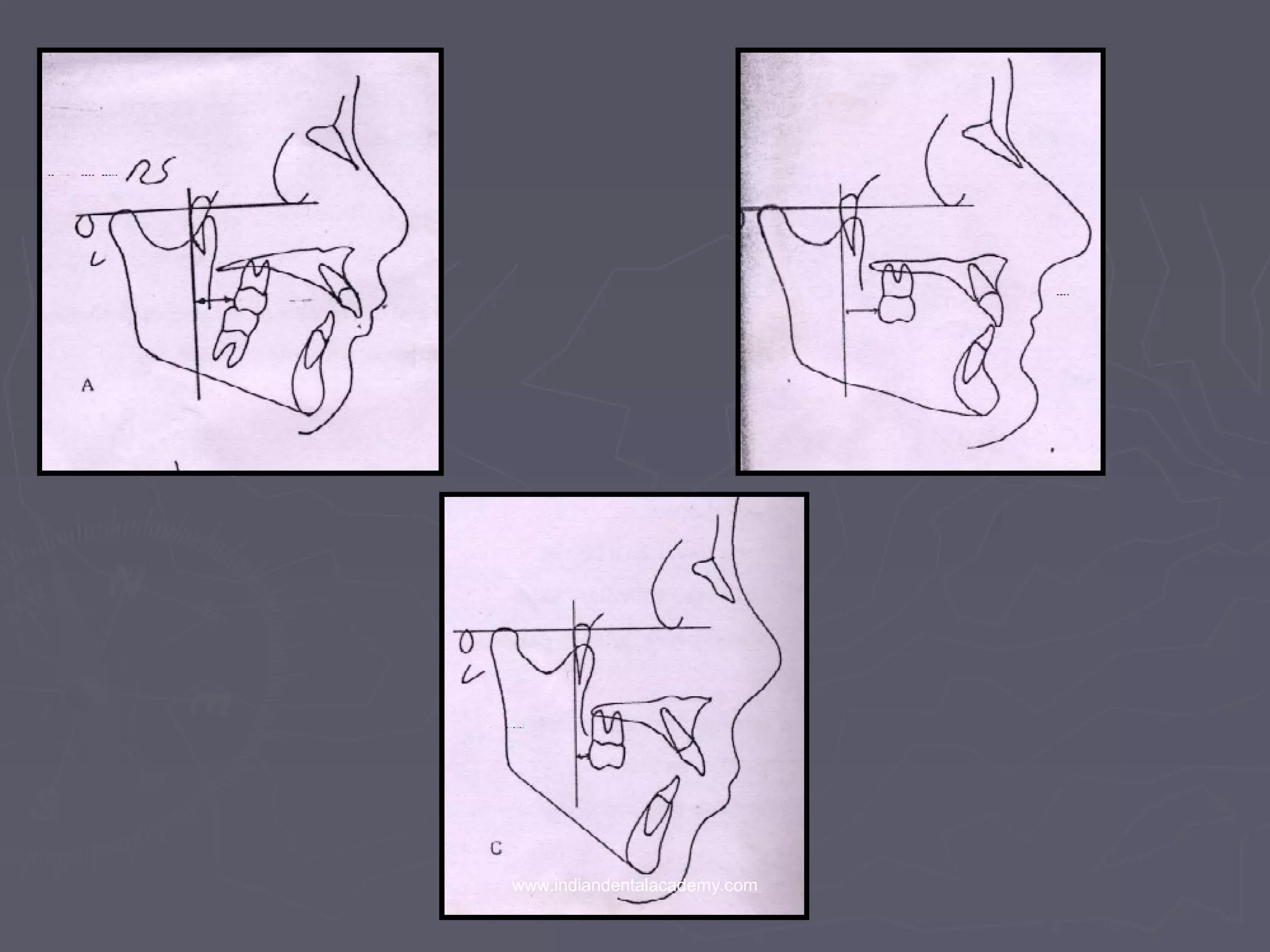 Molar distalization | PPT