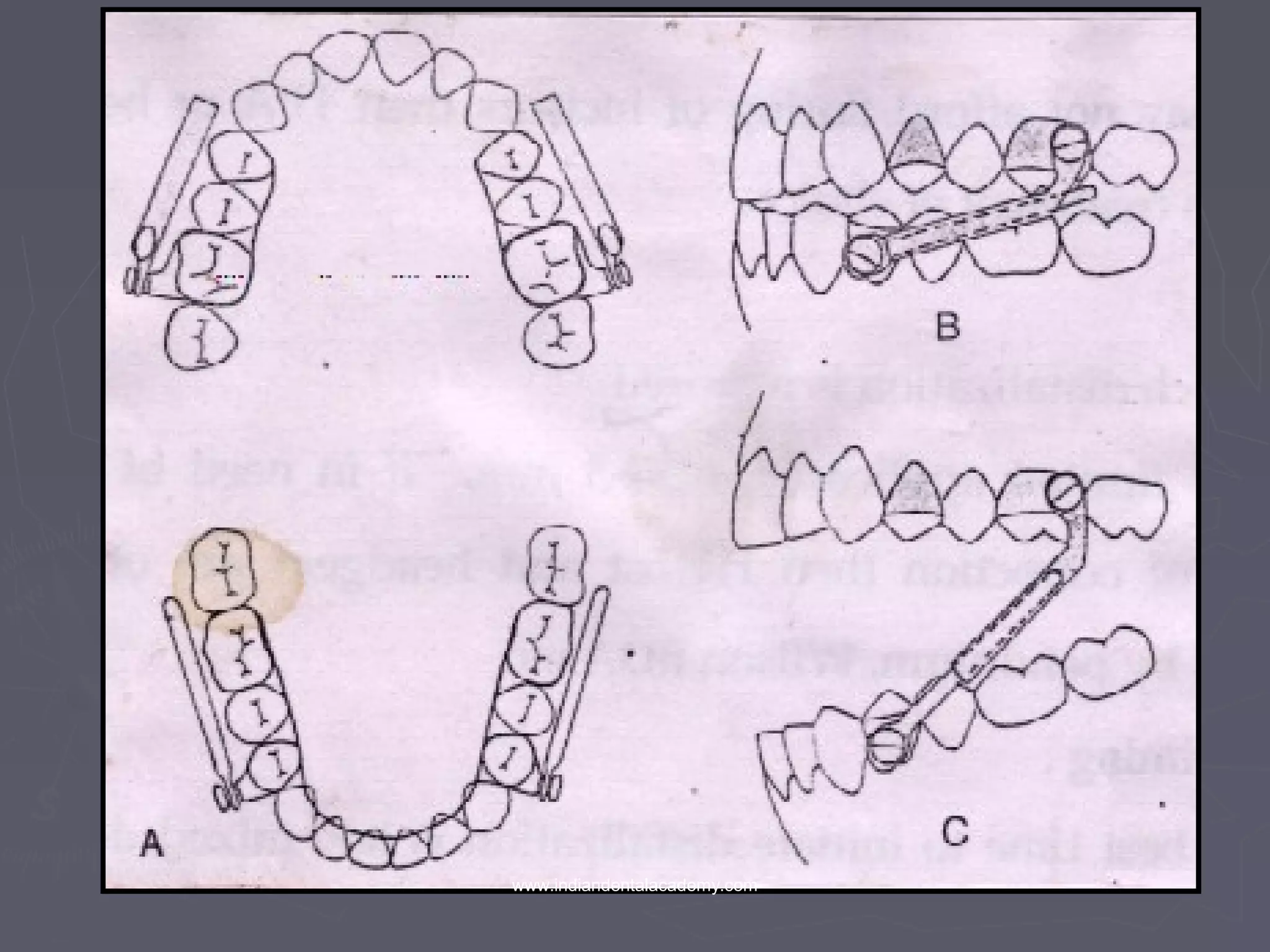 Molar distalization | PPT
