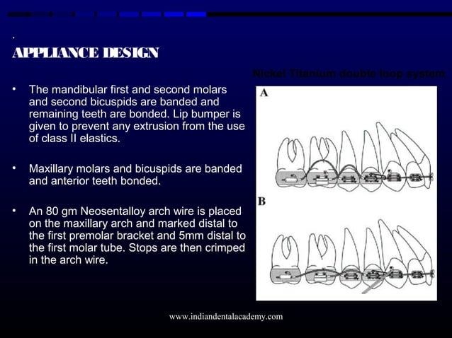 Molar distalization completed | PPT