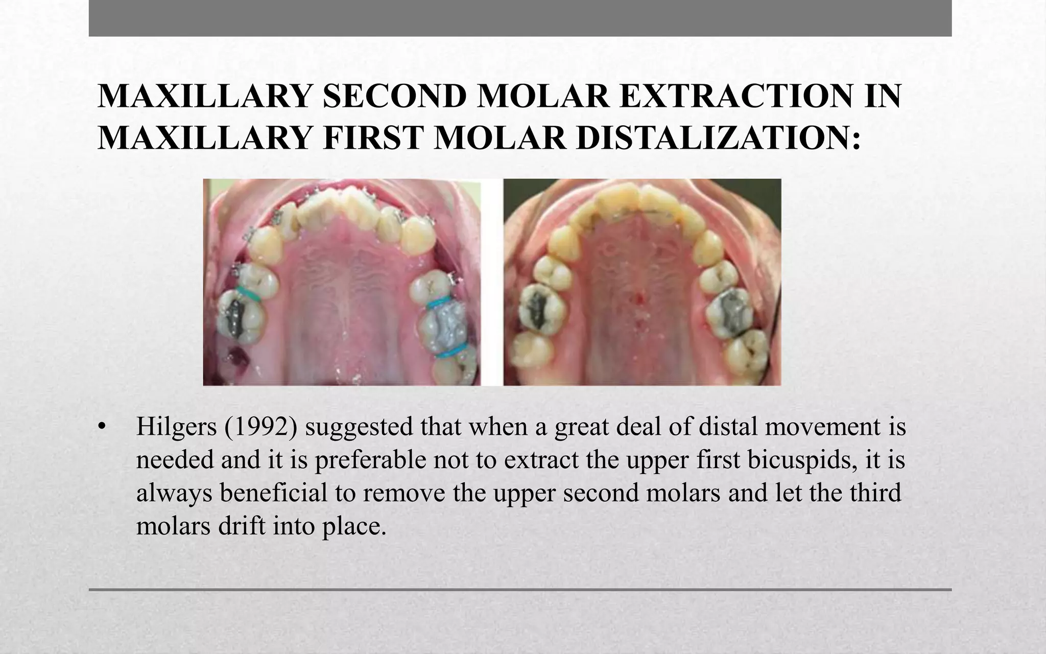 Molar distalisation in Orthodontics | PPTX