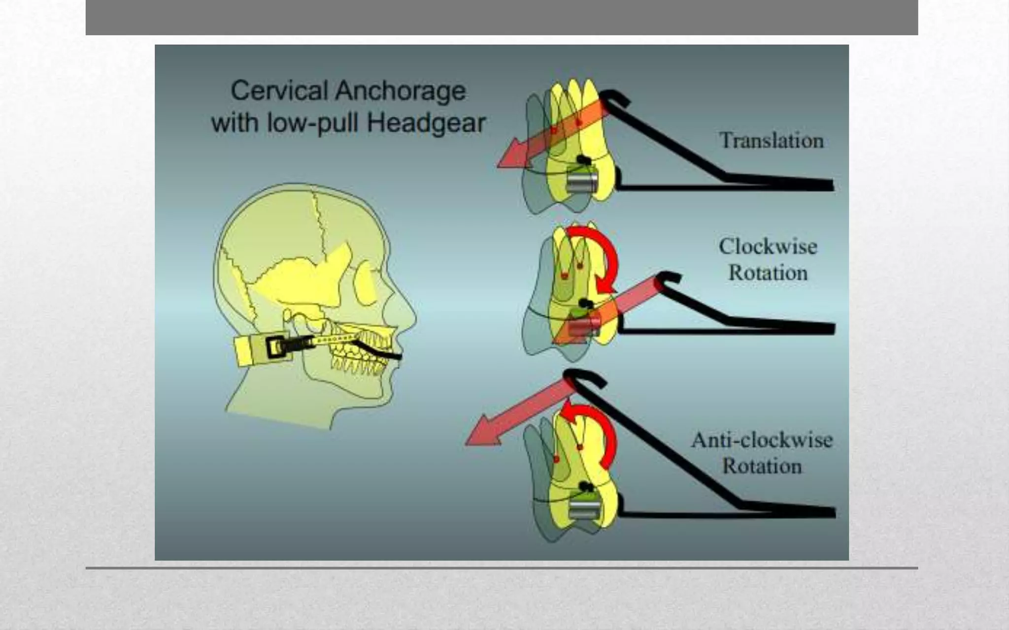 Molar distalisation in Orthodontics | PPTX