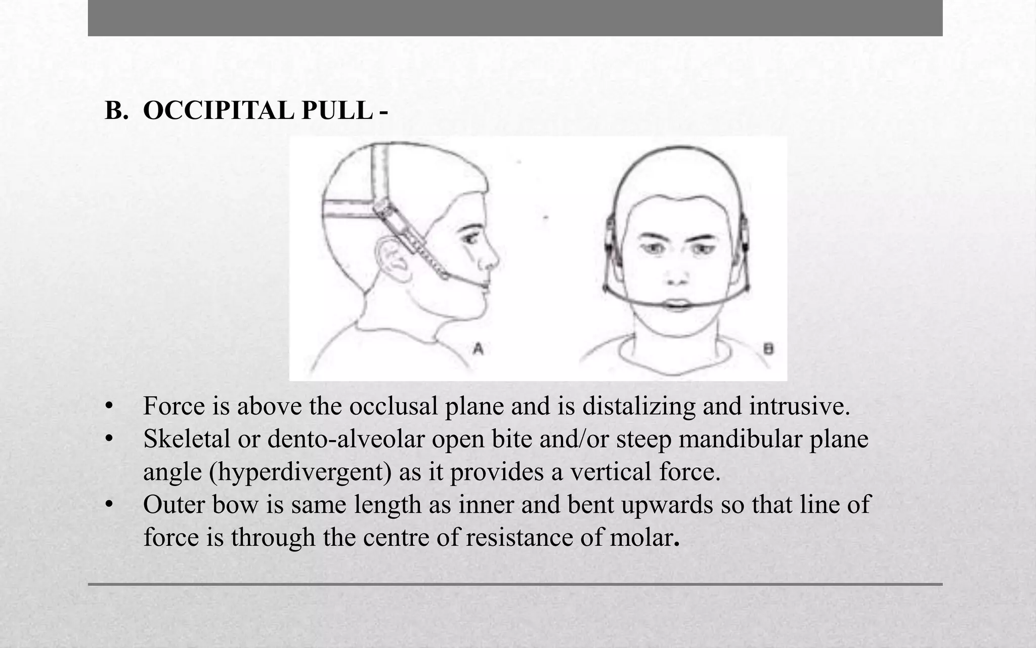 Molar distalisation in Orthodontics | PPTX