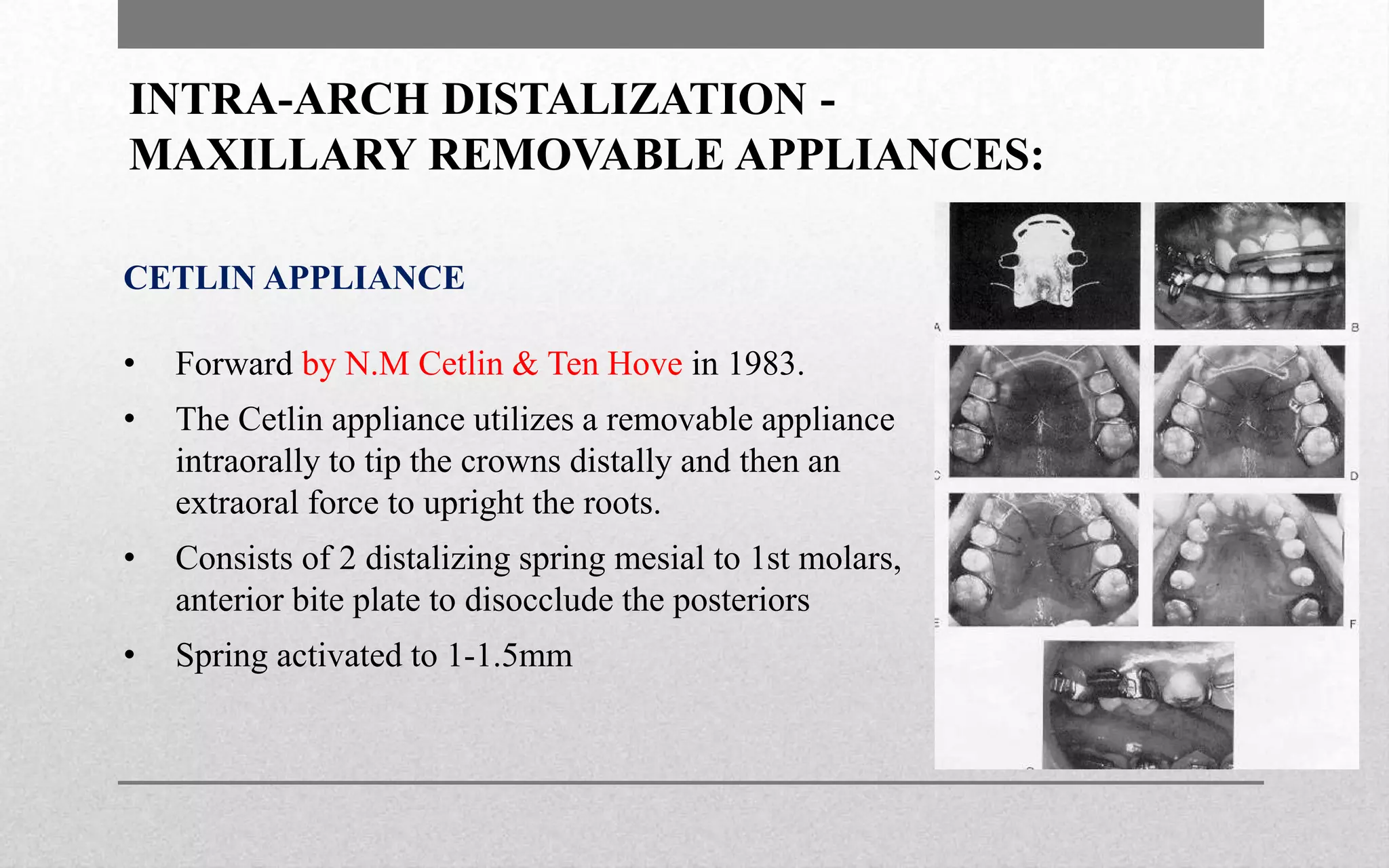 Molar distalisation in Orthodontics | PPTX