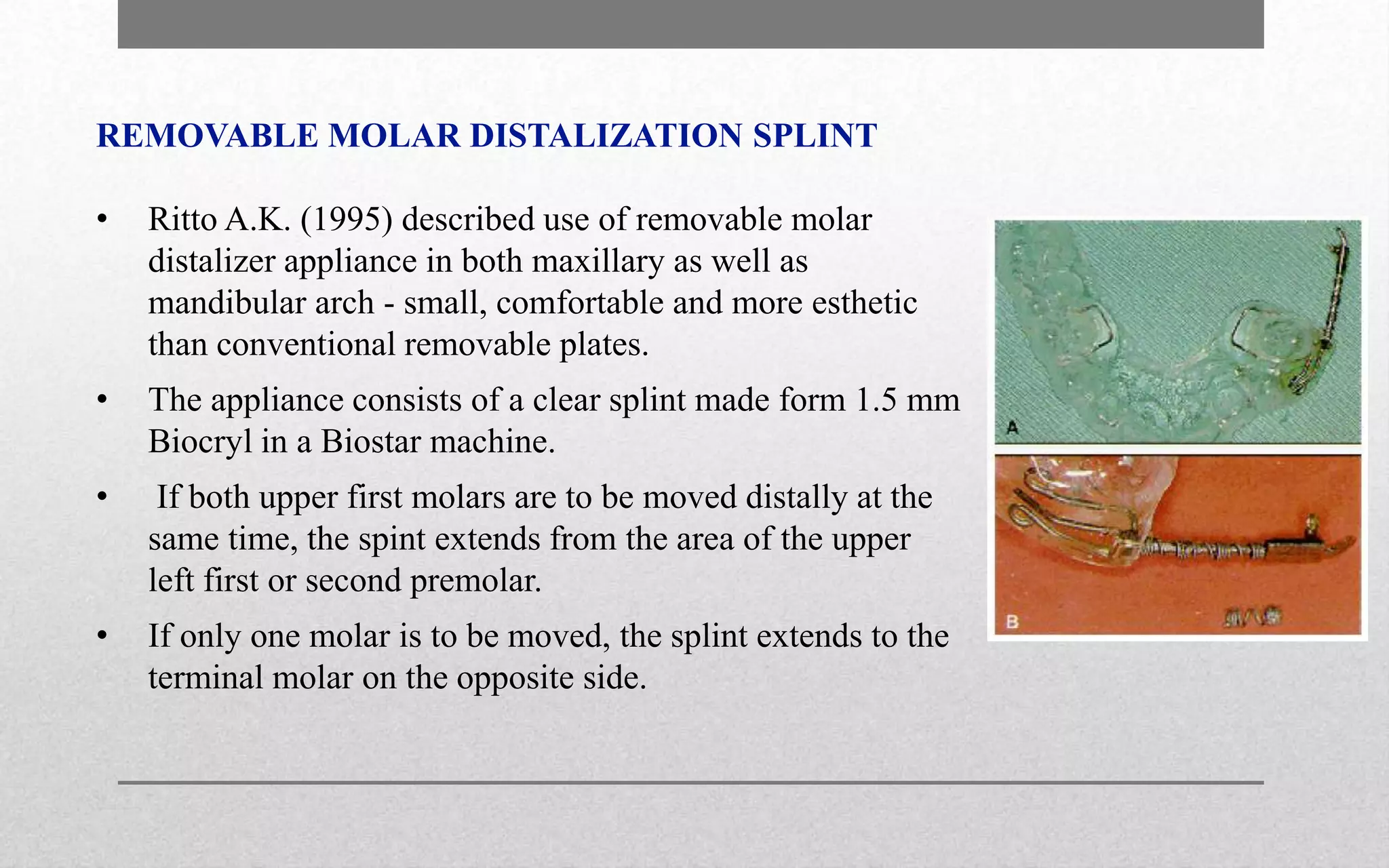 Molar distalisation in Orthodontics | PPTX