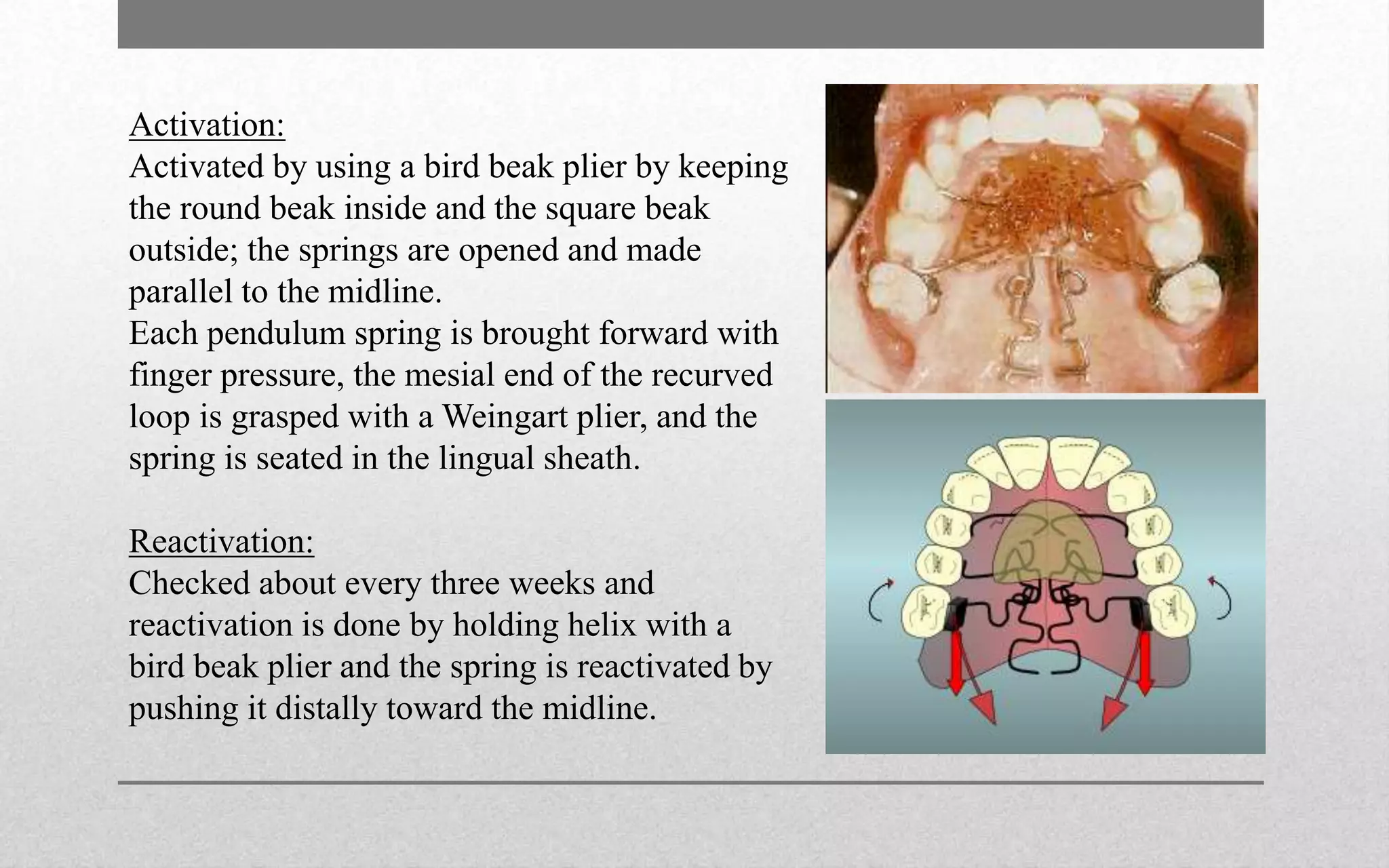 Molar distalisation in Orthodontics | PPTX | Dental Health | Diseases ...