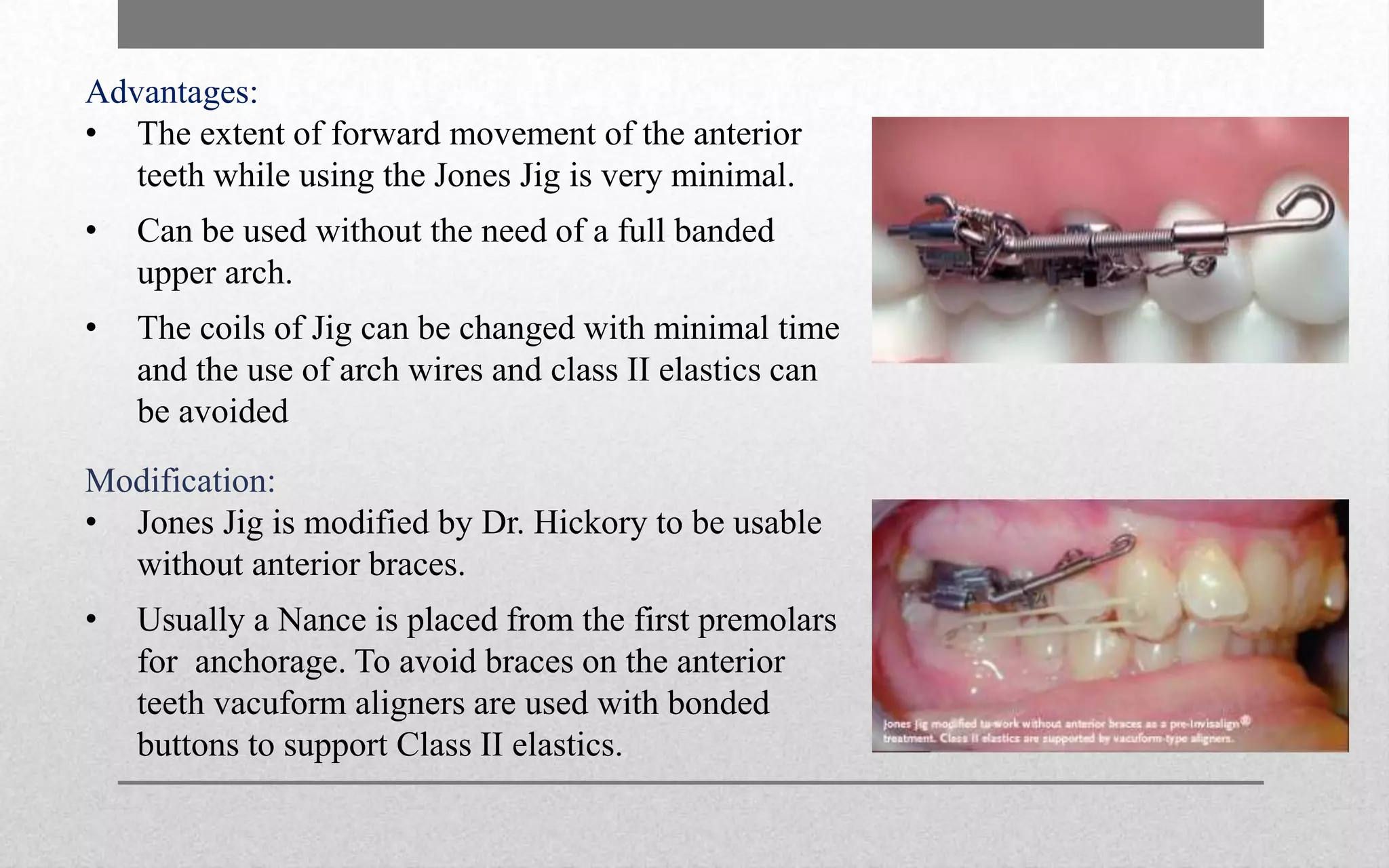 Molar distalisation in Orthodontics | PPTX | Dental Health | Diseases ...