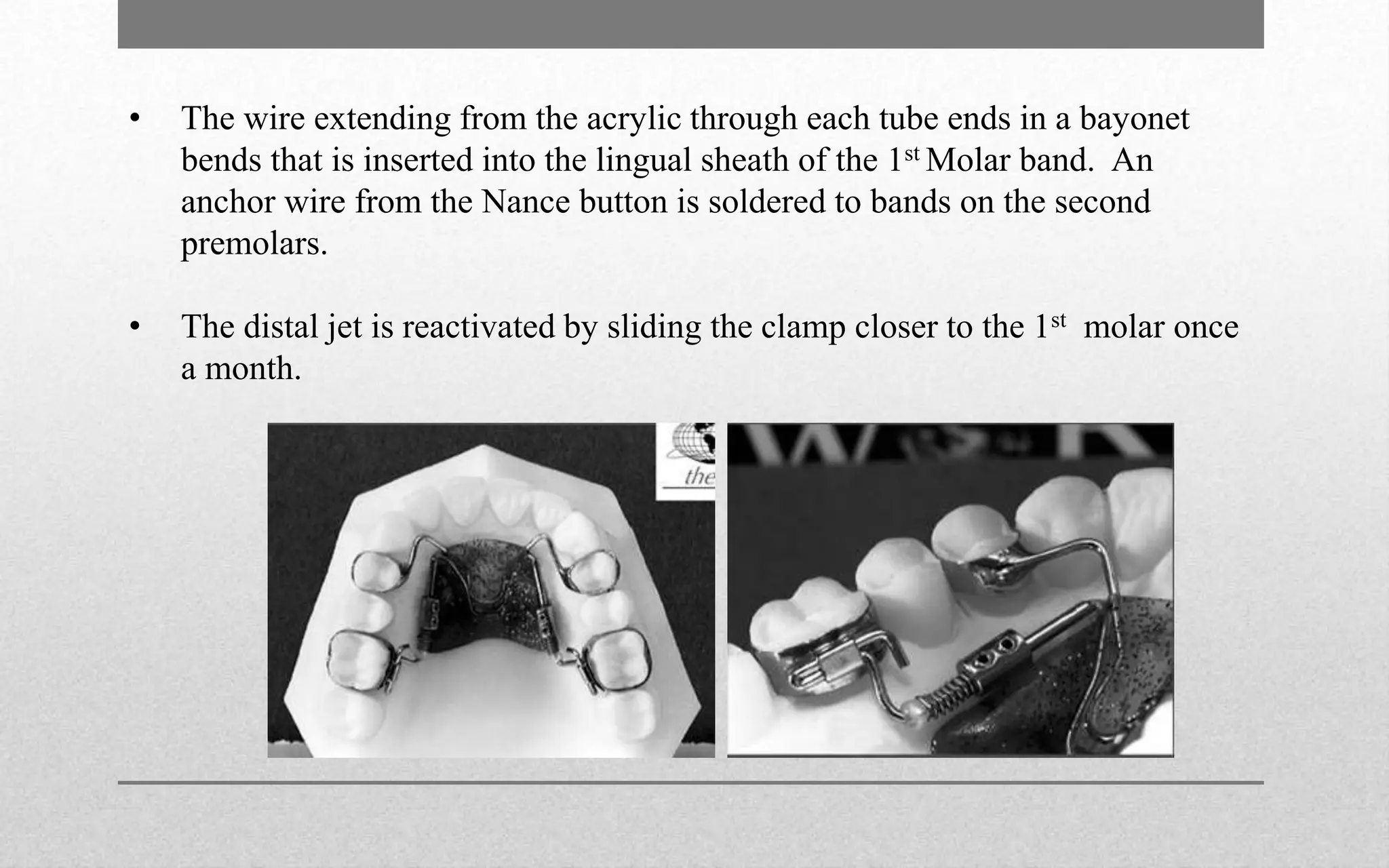 Molar distalisation in Orthodontics | PPTX