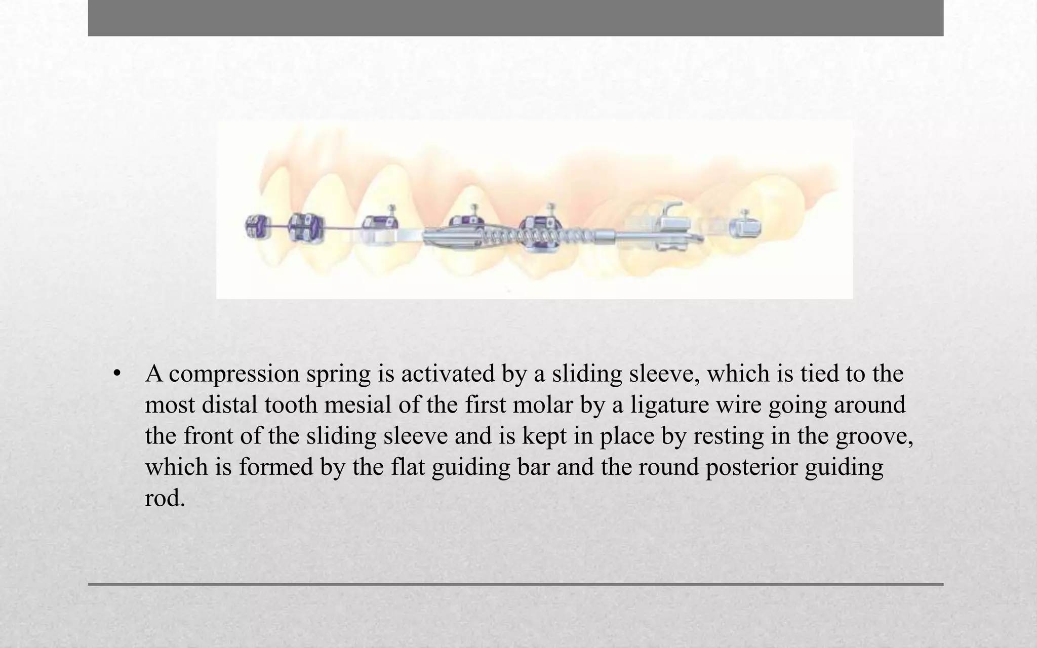Molar distalisation in Orthodontics | PPTX