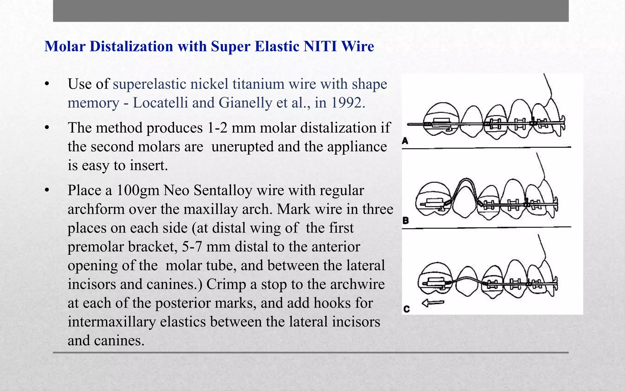 Molar distalisation in Orthodontics | PPTX