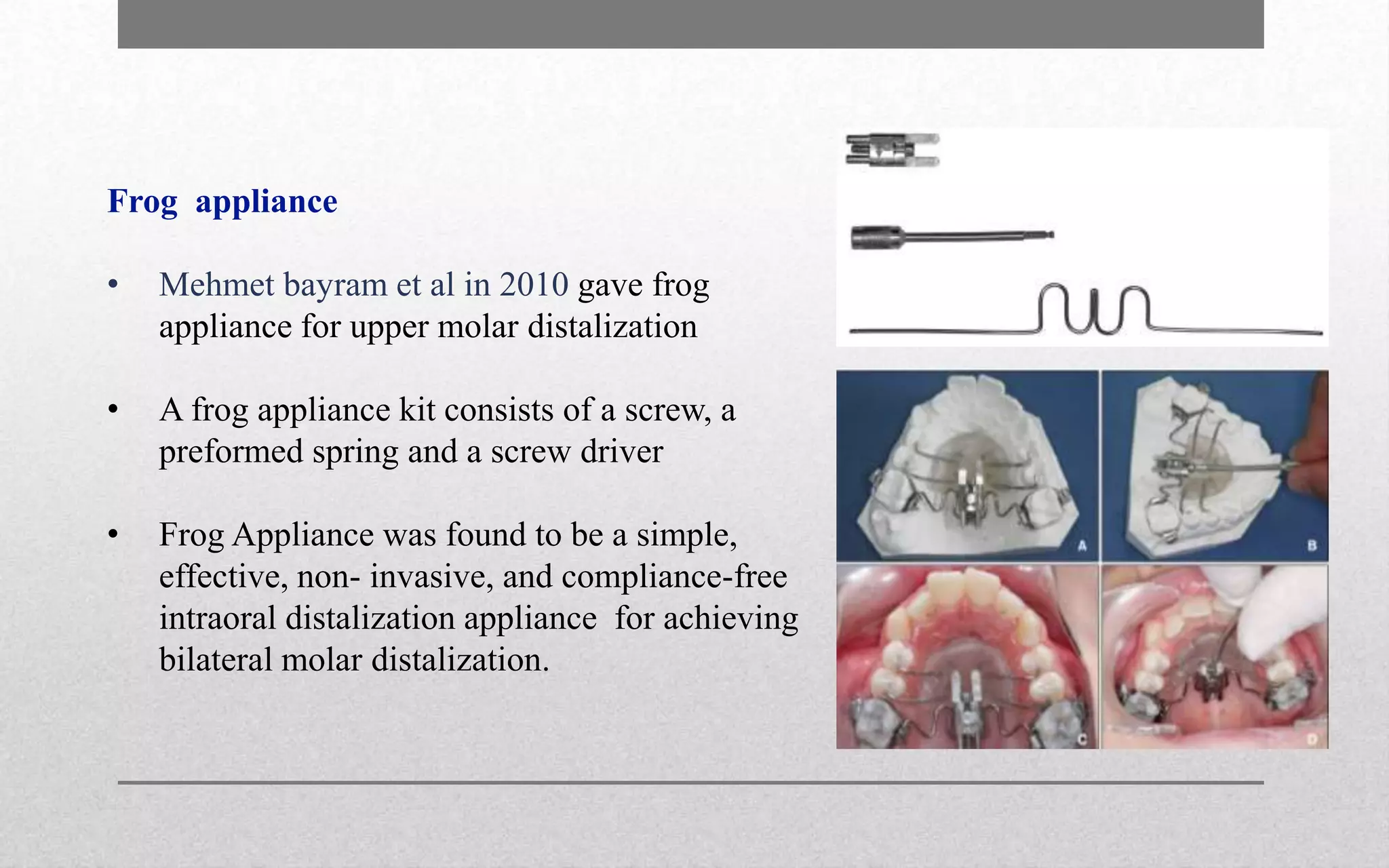 Molar distalisation in Orthodontics | PPTX