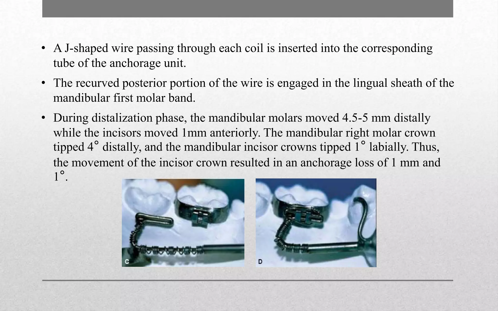 Molar distalisation in Orthodontics | PPTX