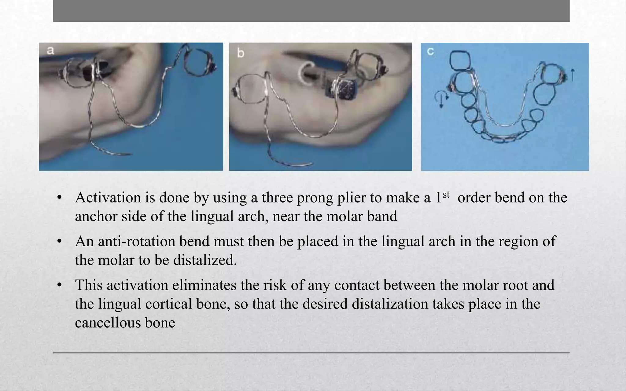 Molar distalisation in Orthodontics | PPTX