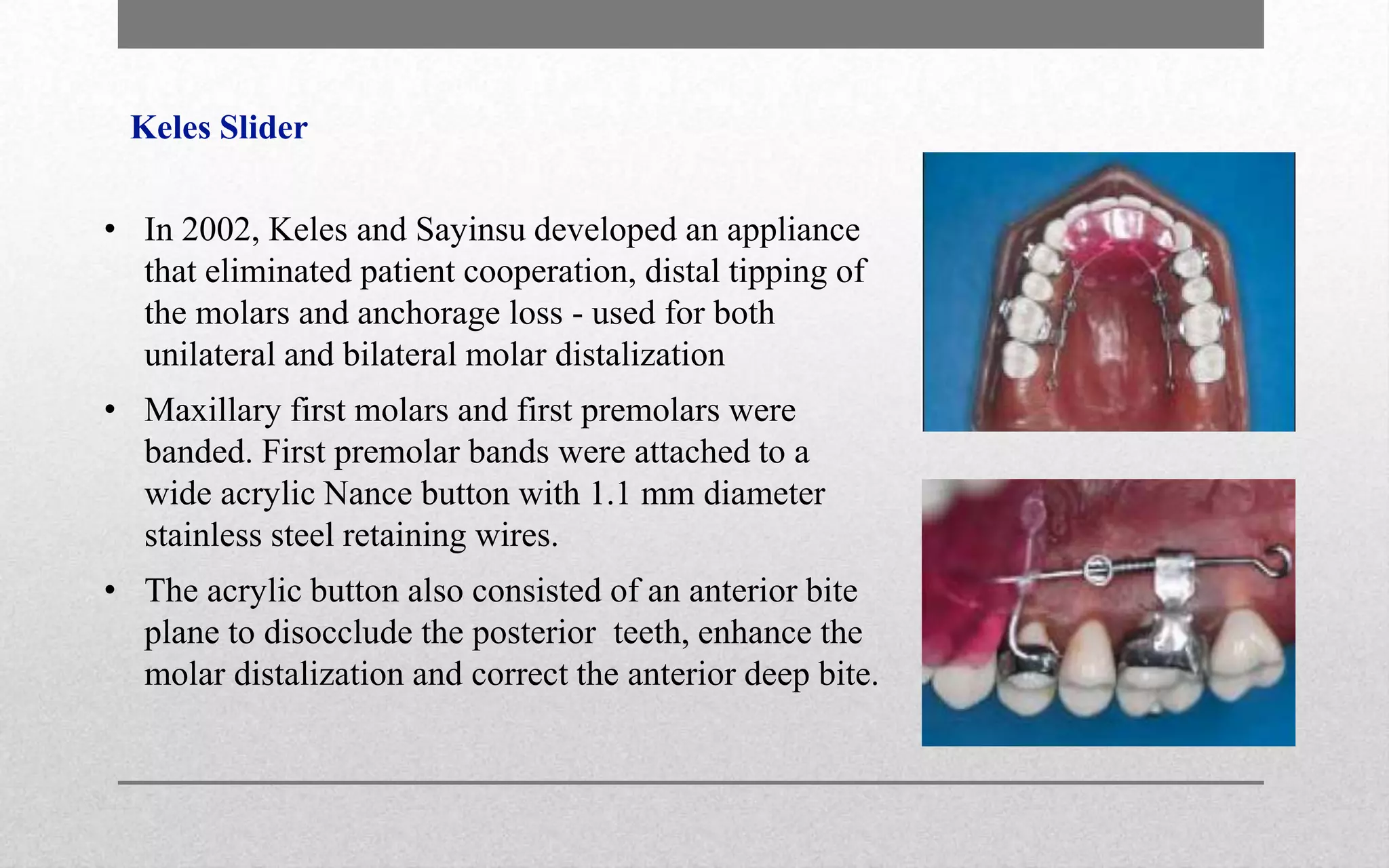 Molar distalisation in Orthodontics | PPTX