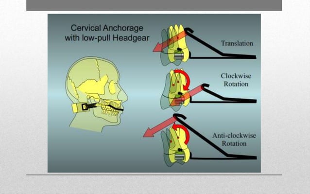 Molar distalisation in Orthodontics | PPTX | Dental Health | Diseases ...