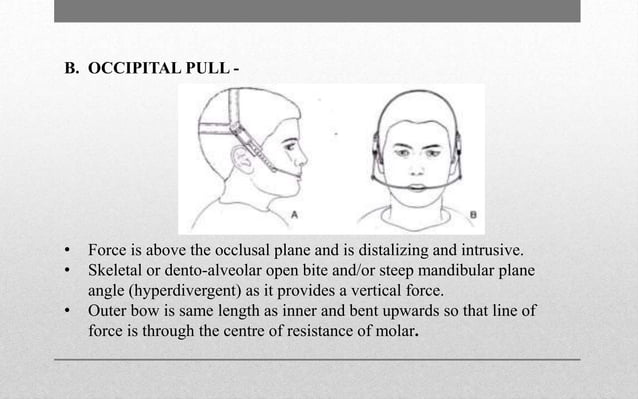 Molar distalisation in Orthodontics | PPTX | Dental Health | Diseases ...