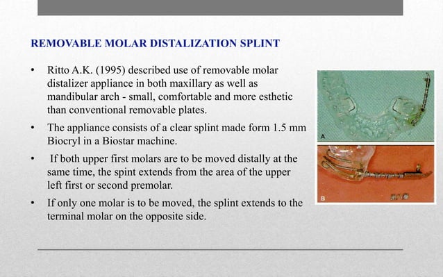 Molar distalisation in Orthodontics | PPTX | Dental Health | Diseases ...
