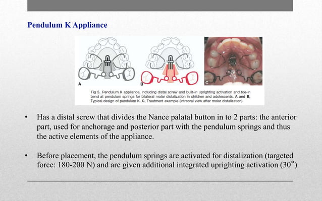 Molar distalisation in Orthodontics | PPTX | Dental Health | Diseases ...