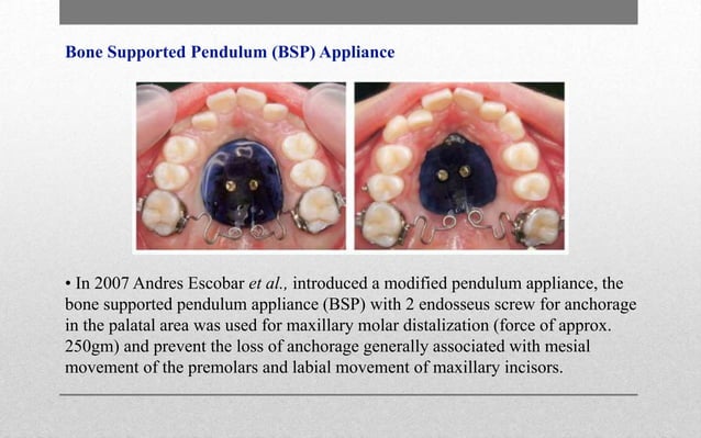 Molar distalisation in Orthodontics | PPTX | Dental Health | Diseases ...