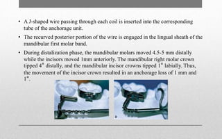 Molar distalisation in Orthodontics | PPTX