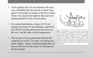 Molar distalisation in Orthodontics | PPTX