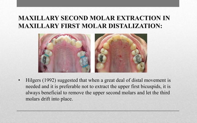 Molar distalisation in Orthodontics | PPT