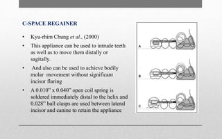 Molar distalisation in Orthodontics | PPT