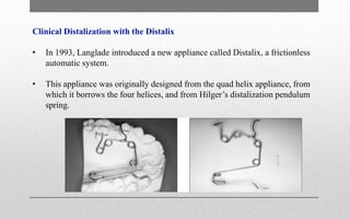 Molar distalisation in Orthodontics | PPT