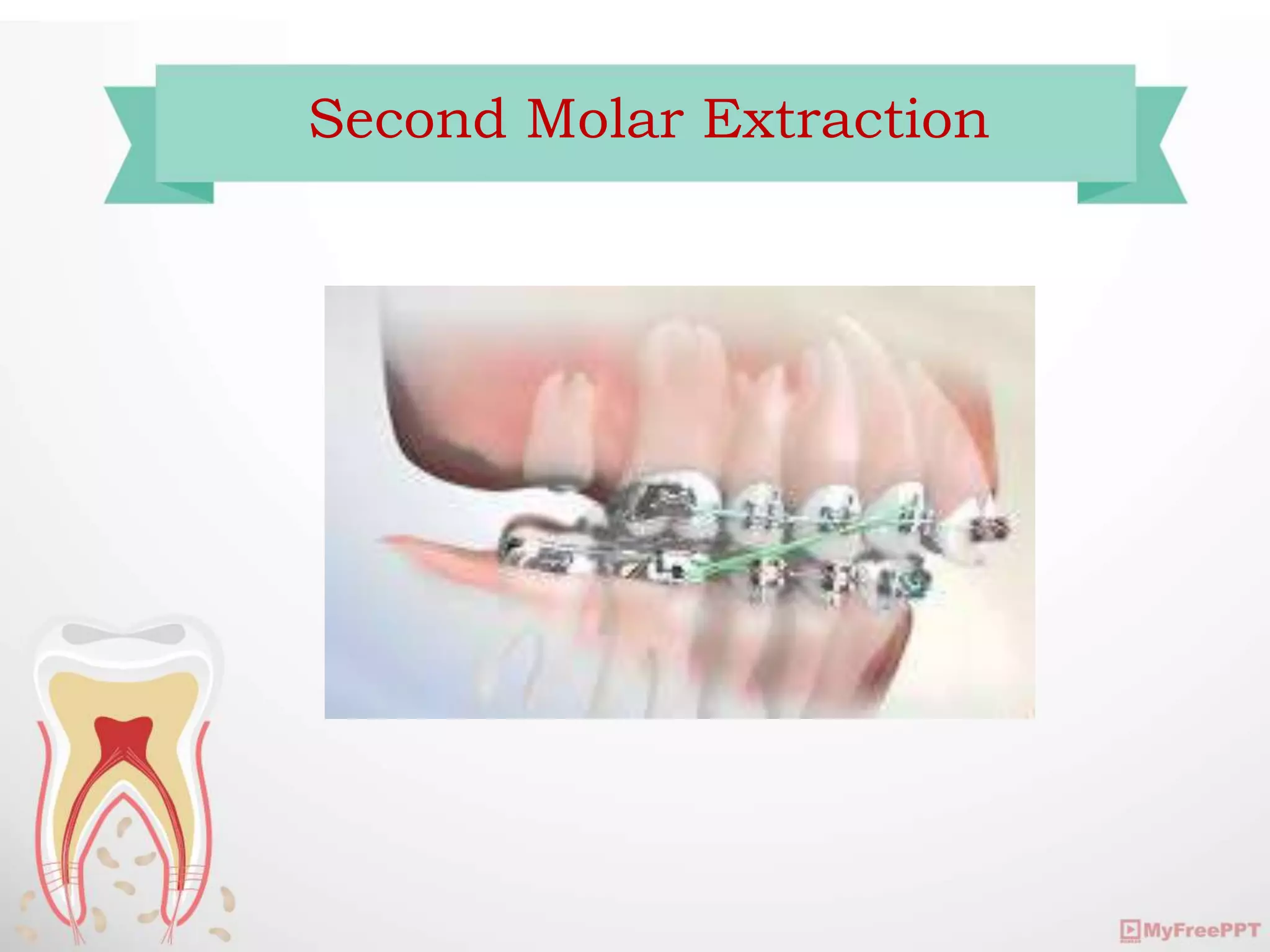 Molar distalization | PPTX