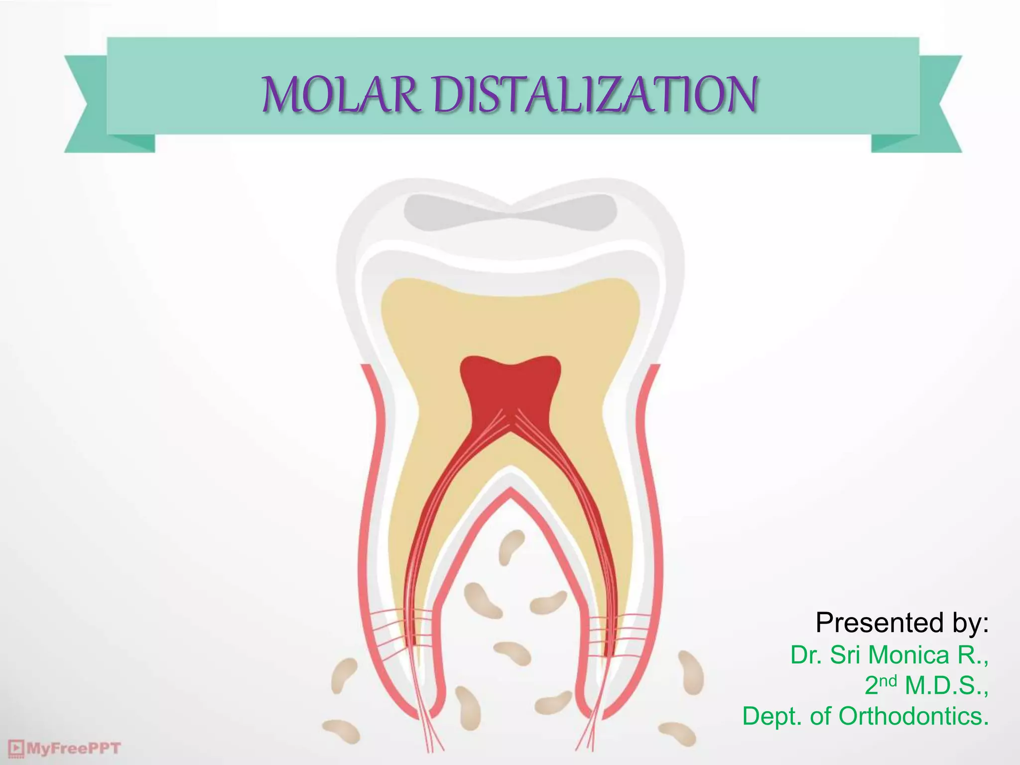 Molar distalization | PPTX