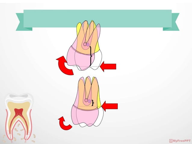 Molar distalization | PPTX