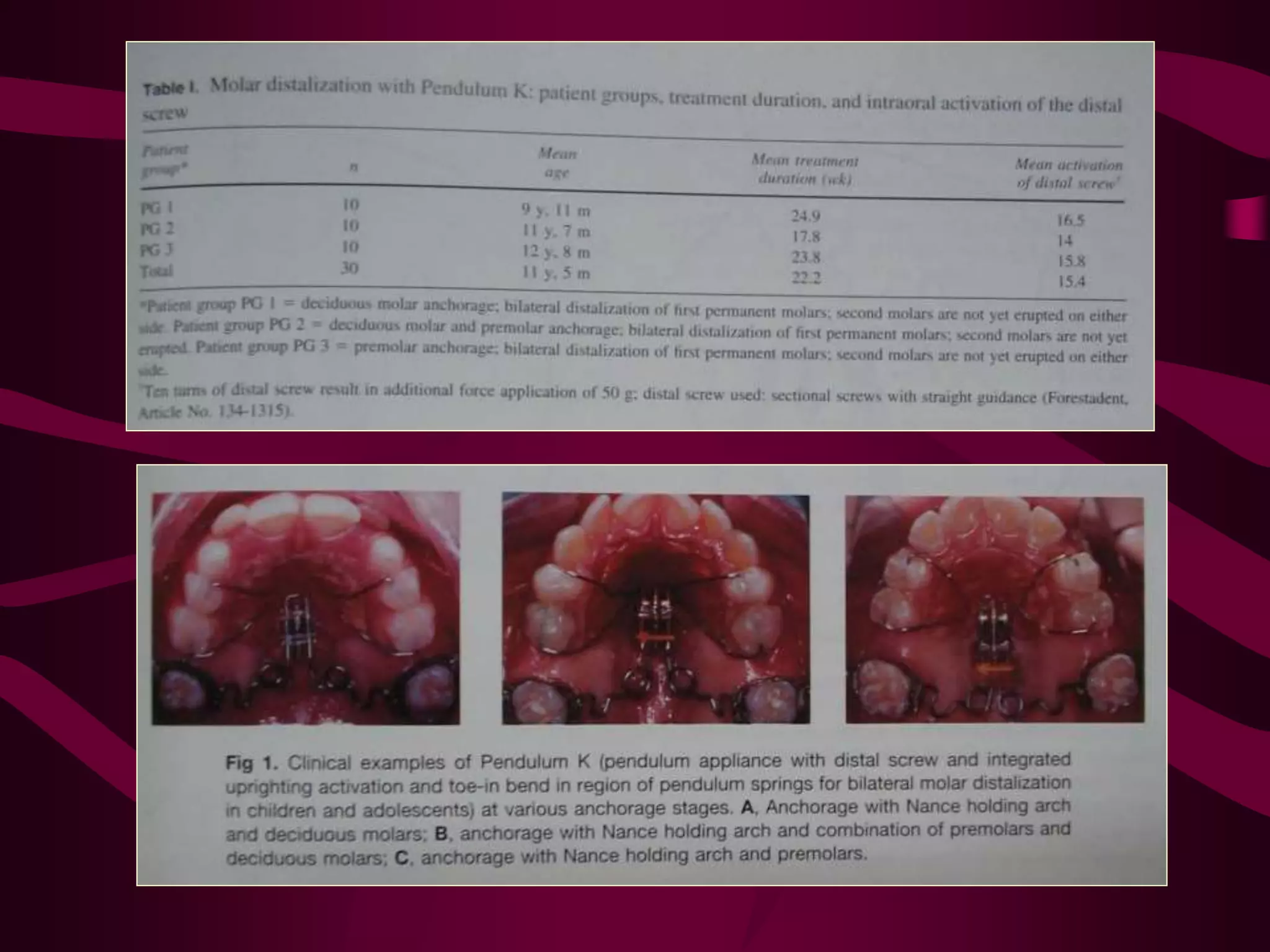 molar distallisation with pendulum appliance JC | PPT