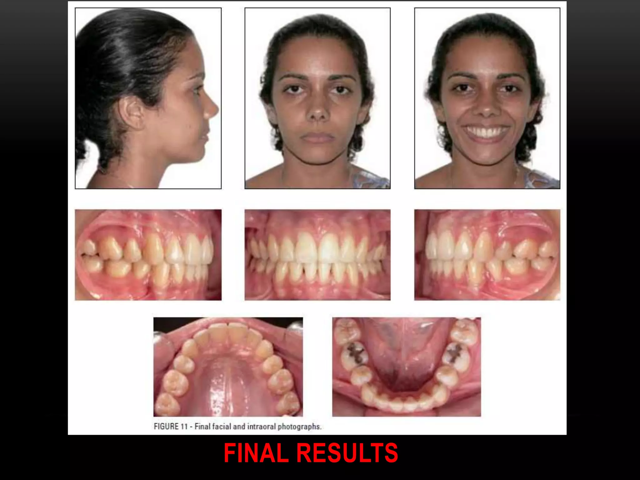 Molar extractions in orthodontics | PPT