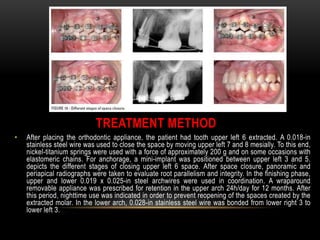 Molar extractions in orthodontics | PPTX