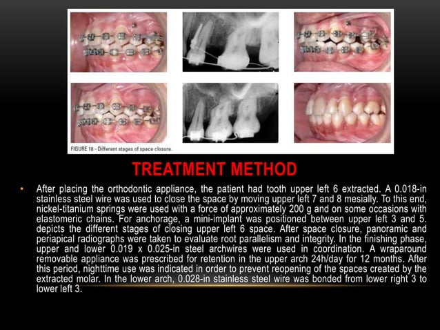 Molar extractions in orthodontics | PPT