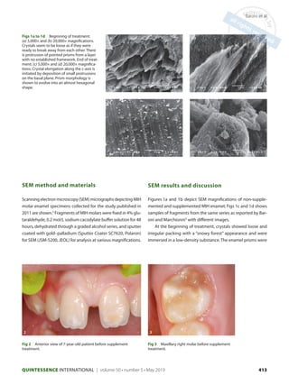 Molar incisor hypo | PDF