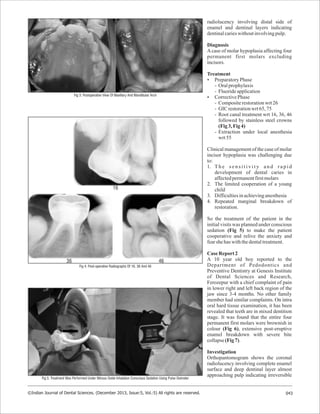 Molar incisor hypomineralization | PDF