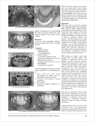 Molar incisor hypomineralization | PDF
