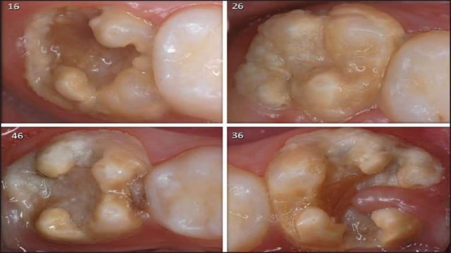 MOLAR INCISOR HYPOMINERALIZATION2.pptx